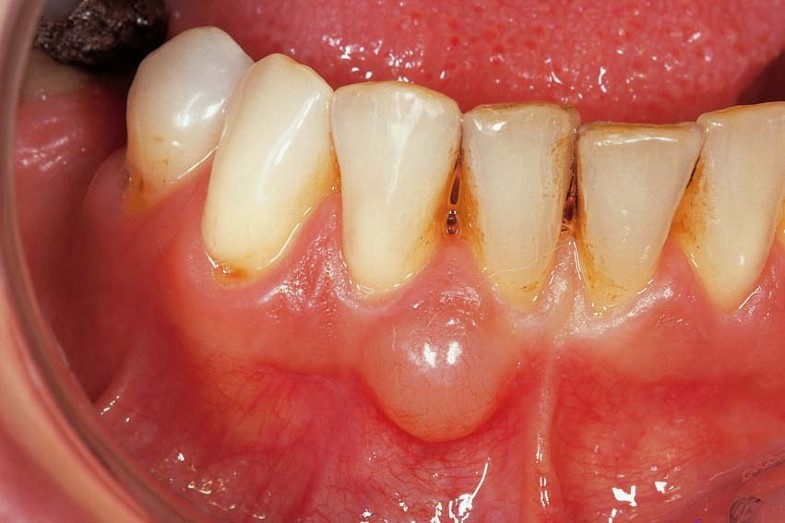 11 Dentogene cysten en tumoren | SpringerLink