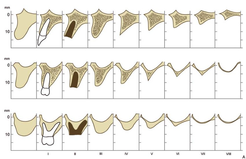 20 Preprothetische en implantologische chirurgie | SpringerLink