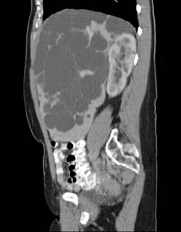 17 Levercysten | SpringerLink