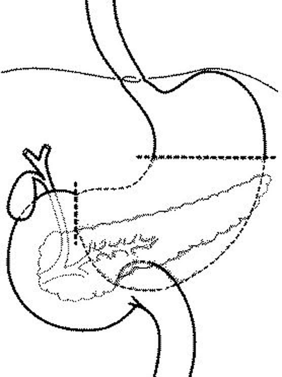 10 Maagcarcinoom | SpringerLink