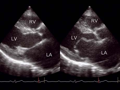 12 De mitralisklep | SpringerLink