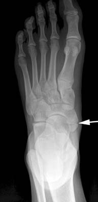 10 Een frequent recidiverende enkeldistorsie veroorzaakt mediale ...