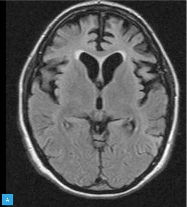 19 Frontotemporale dementie (FTD) | SpringerLink