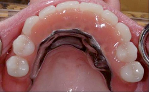 Behandeling van de edentate bovenkaak: brug of overkappingsprothese ...