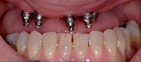 Behandeling van de edentate bovenkaak: brug of overkappingsprothese ...