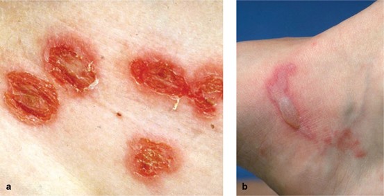 De huid in de differentiaaldiagnose van kindermishandeling | SpringerLink