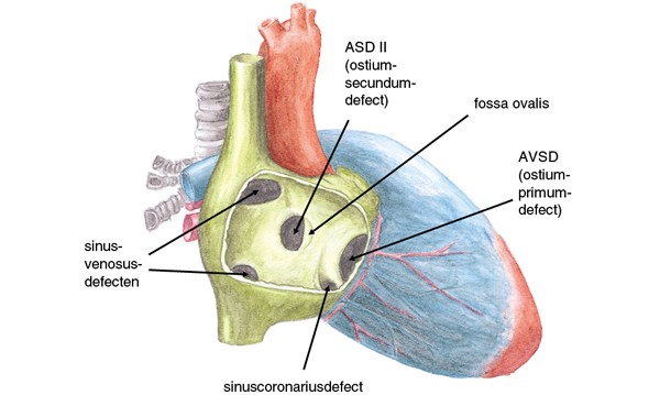 Atriumseptumdefect, persisterend foramen ovale en abnormale ...