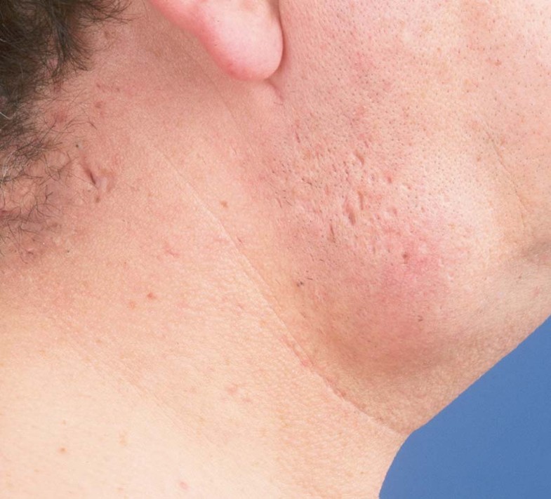 19 Folliculosen waaronder acne vulgaris | SpringerLink