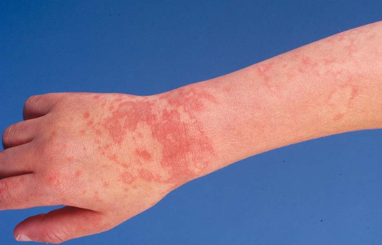 35 Virale huidaandoeningen | SpringerLink