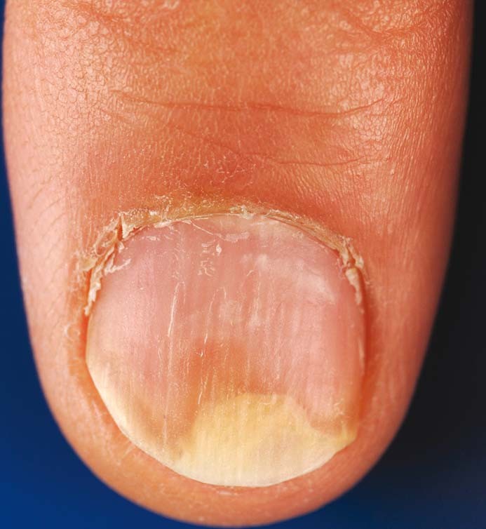 8 Psoriasis en andere erythematosquameuze dermatosen | SpringerLink