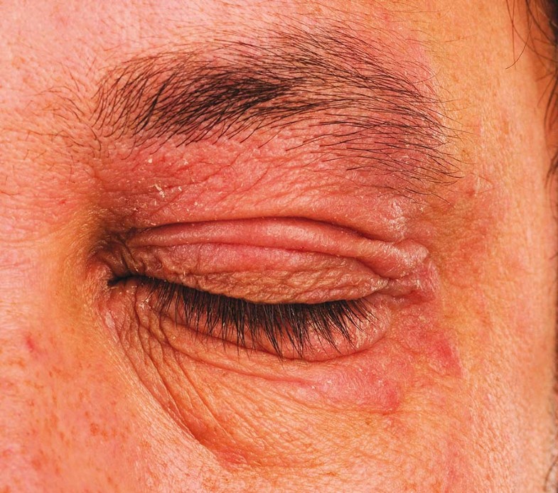 9 Eczemateuze dermatosen | SpringerLink