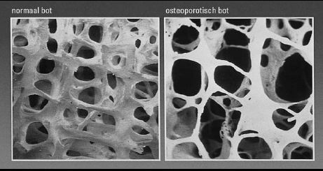 Osteoporose en voeding | SpringerLink