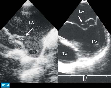 De mitralisklep | SpringerLink