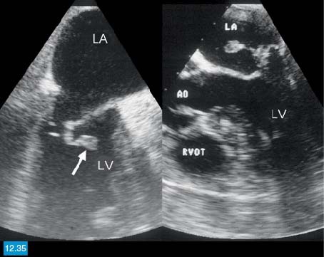 De mitralisklep | SpringerLink