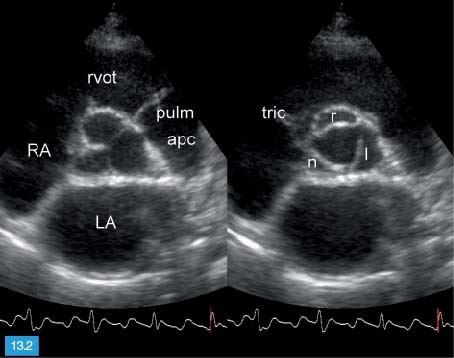 De aortaklep | SpringerLink