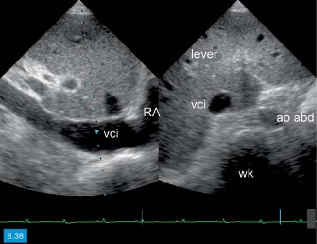 Linker en rechter atrium | SpringerLink