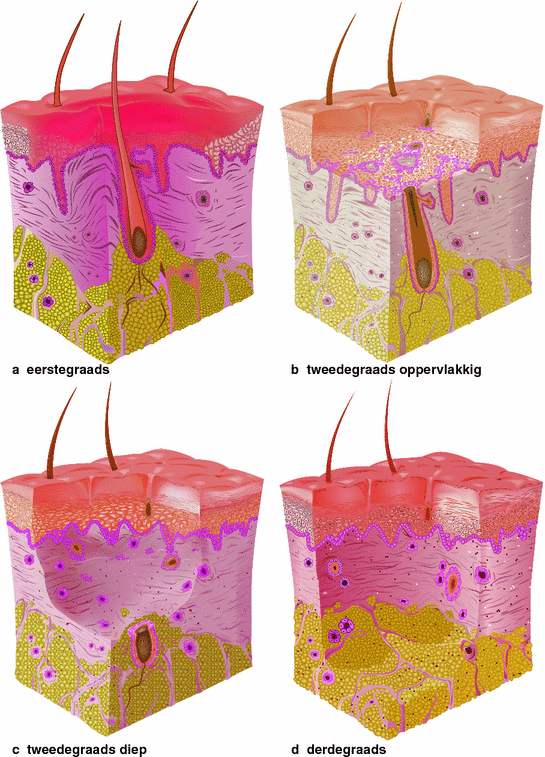 Voeding bij brandwonden | SpringerLink
