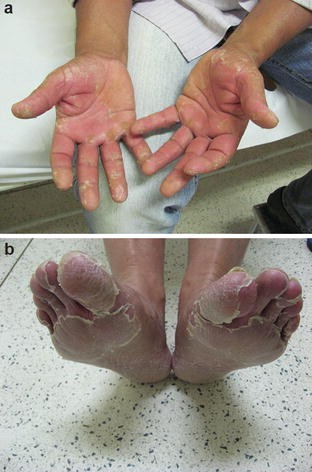 Loxosceles and Loxoscelism: Biology, Venom, Envenomation and Treatment ...