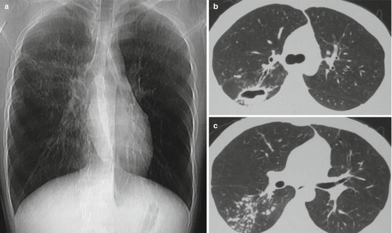 Pulmonary Tuberculosis | SpringerLink