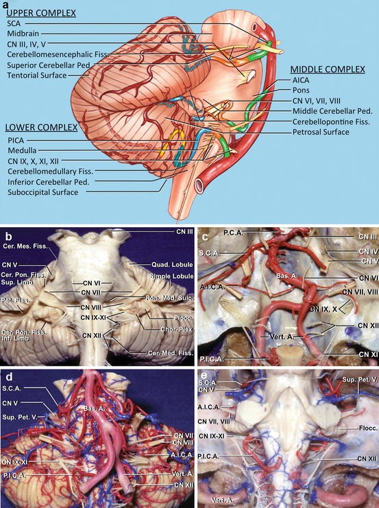 Microsurgical Anatomy for Microvascular Decompression Surgery ...