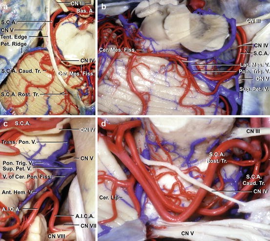 Microsurgical Anatomy for Microvascular Decompression Surgery ...
