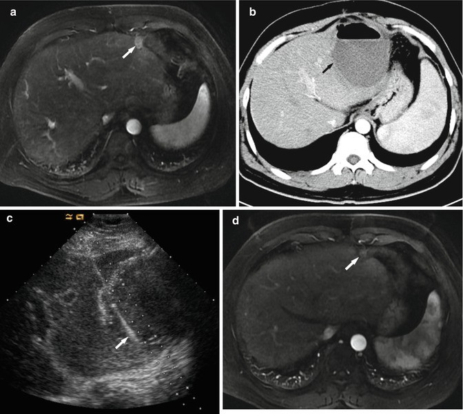 Complications of Microwave Ablation for Liver Tumors | SpringerLink