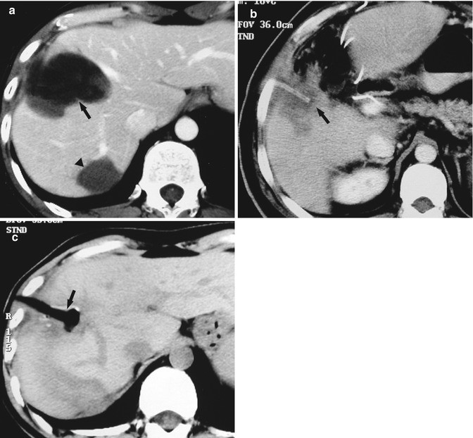 Complications of Microwave Ablation for Liver Tumors | SpringerLink