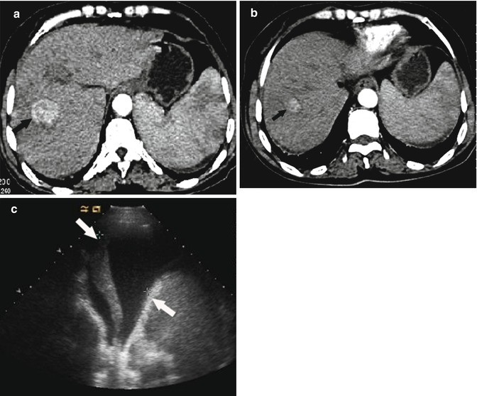 Complications of Microwave Ablation for Liver Tumors | SpringerLink