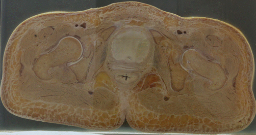Surgical Anatomy of the Retroperitoneal and Pelvic Extraperitoneal ...