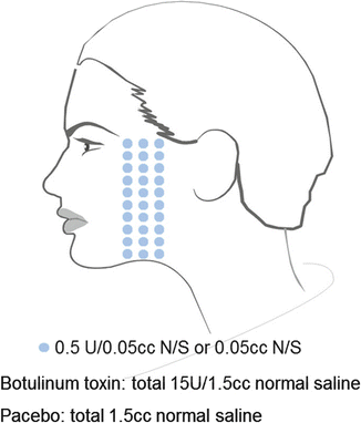 Multiple Intradermal Botulinum Toxin Injections | SpringerLink