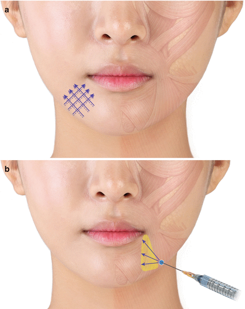 Clinical Anatomy of the Lower Face for Filler Injection | SpringerLink