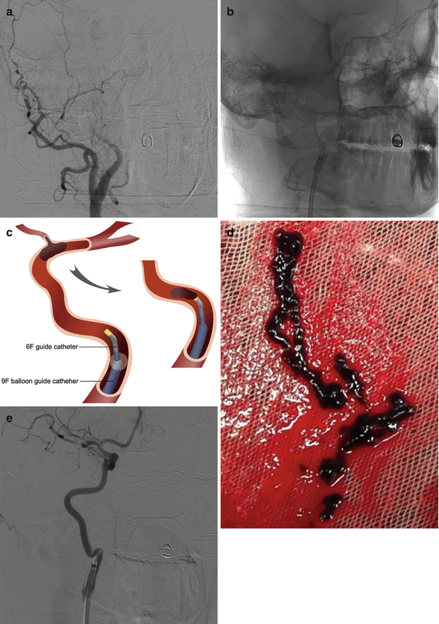 Clot Aspiration Thrombectomy in Acute Ischemic Stroke | SpringerLink