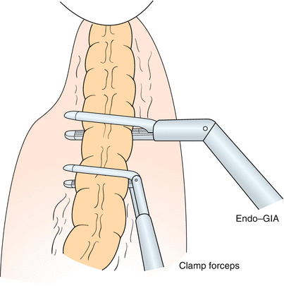 Laparoscopic Sigmoidectomy | SpringerLink