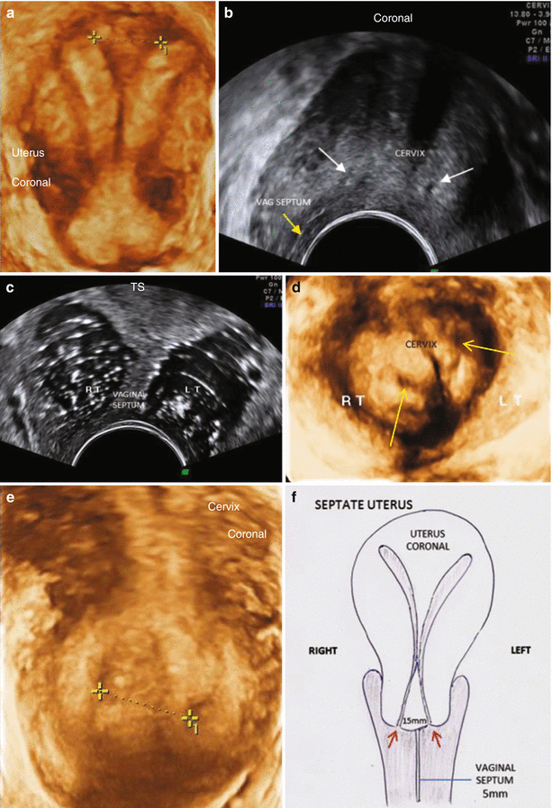 Ultrasound Evaluation of Congenital Uterine Anomalies | SpringerLink