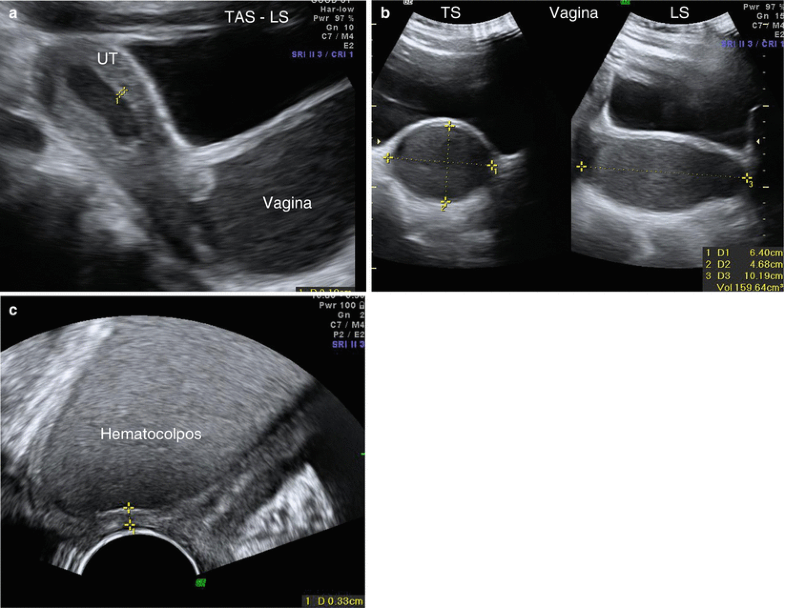 Ultrasound Evaluation of Congenital Uterine Anomalies | SpringerLink