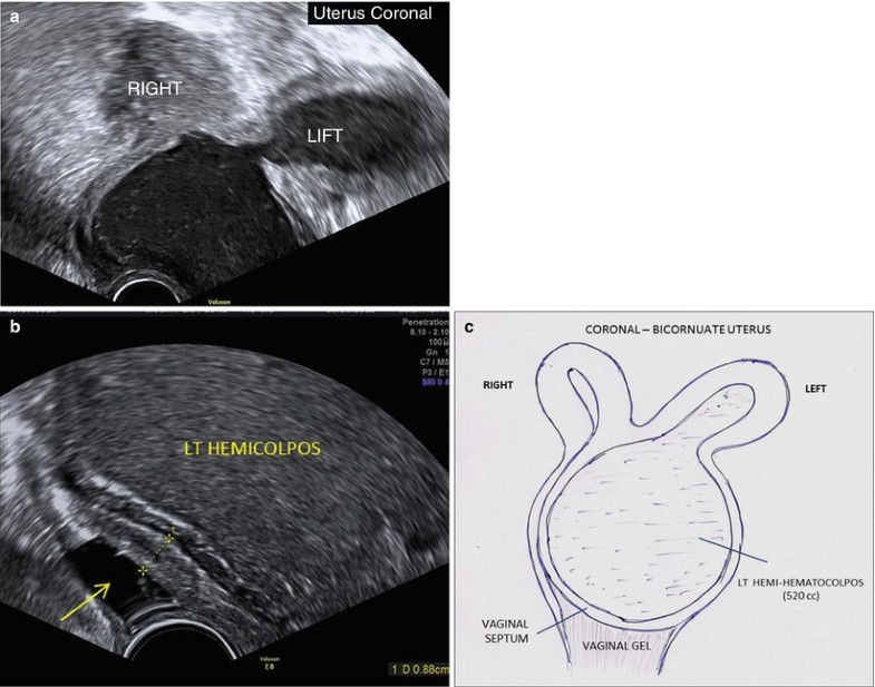 Ultrasound Evaluation of Congenital Uterine Anomalies | SpringerLink