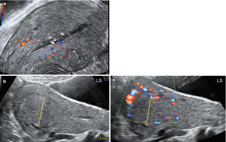 Ultrasound Evaluation of Endometrium | SpringerLink