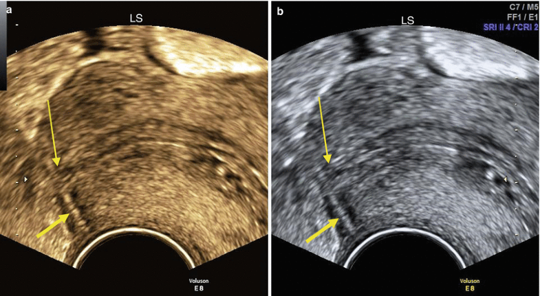Ultrasound Evaluation of the Cervix | SpringerLink