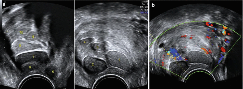 Ultrasound Evaluation of the Cervix | SpringerLink