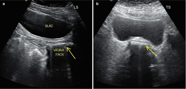 Ultrasound Evaluation of the Vagina | SpringerLink