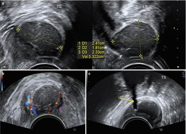 Ultrasound Evaluation of the Vagina | SpringerLink