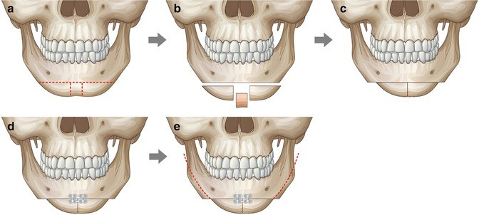 The V-Line Surgery: Narrowing Genioplasty with Mandible Reduction ...