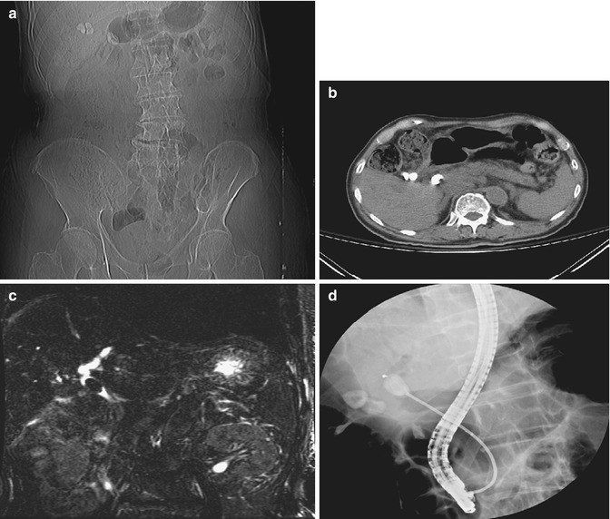 Fundamentals of ERCP: Indications, Equipment, and Preparation ...