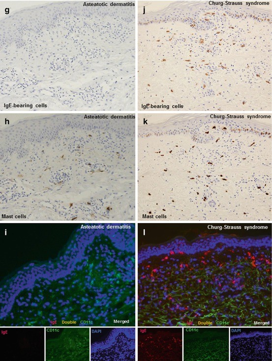 Senile Atopic Dermatitis | SpringerLink