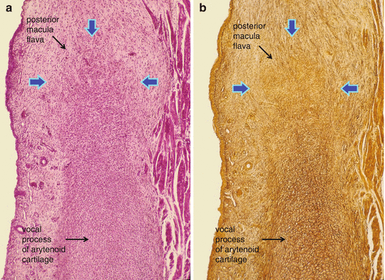 Macula Flava of the Human Newborn Vocal Fold | SpringerLink