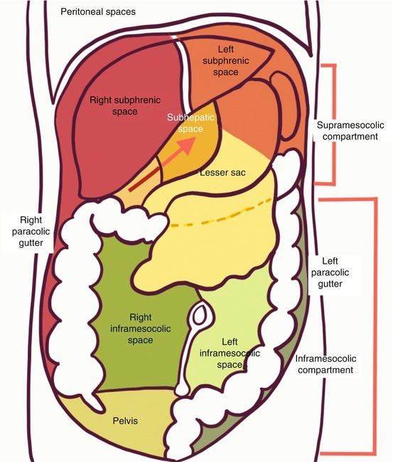 Cytoreductive Surgery for Peritoneal Metastases: Principles and ...