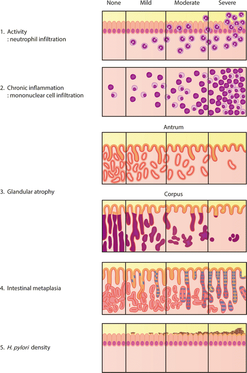 Atrophic Gastritis and Intestinal Metaplasia | SpringerLink