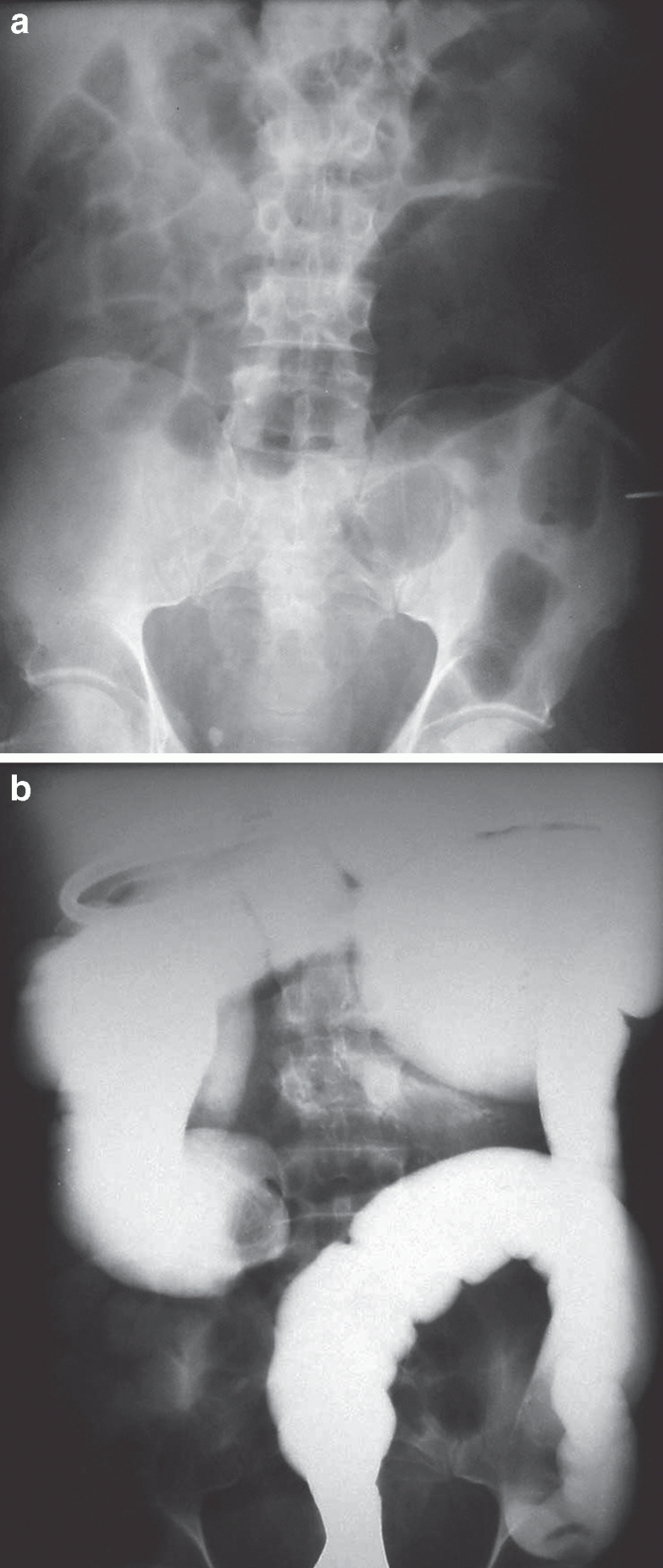 Colonic Volvulus | SpringerLink
