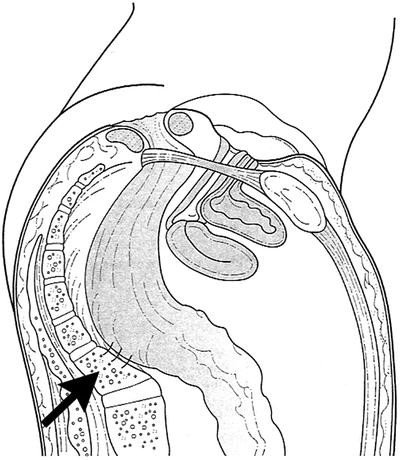 Recurrent Rectal Prolapse | SpringerLink