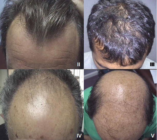 Male androgenetic alopecia | SpringerLink